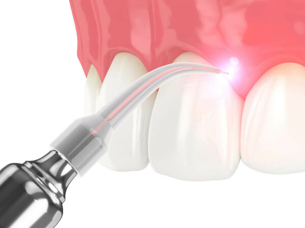 Diode Laser Dentistry Brooklyn, NY | Onatsky Dental Clinic